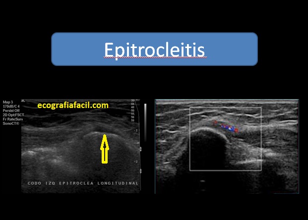 La Ecogenicidad – Ecografía Fácil