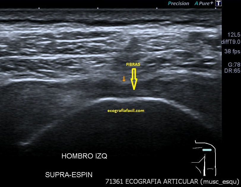 Bursitis – Ecografía Fácil