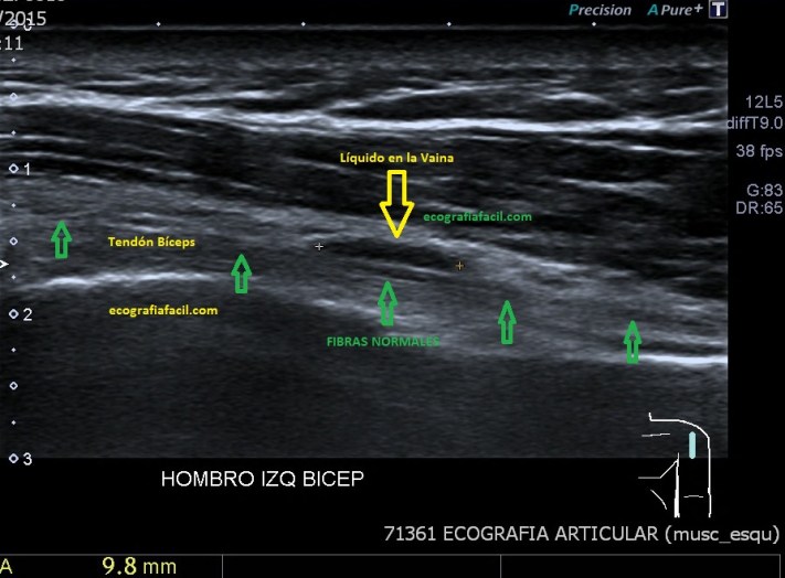 Bursitis – Ecografía Fácil