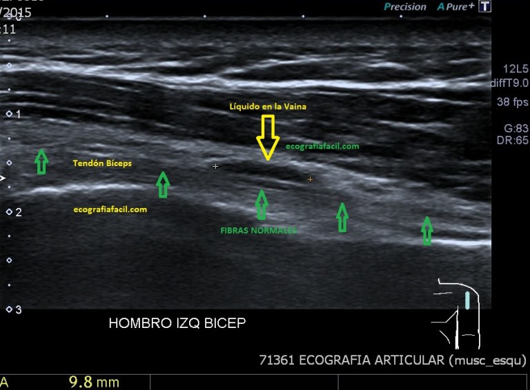 Bursitis – Ecografía Fácil