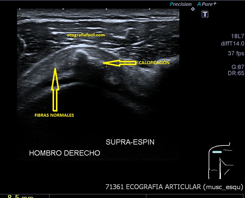 Bursitis – Ecografía Fácil
