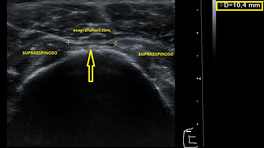 Ecografía de Hombro – Ecografía Fácil