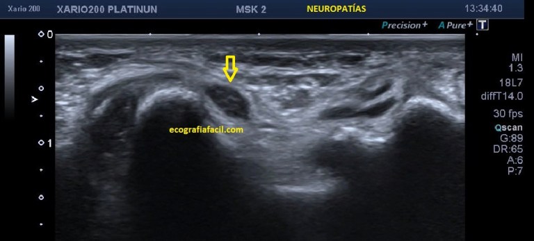La Ecogenicidad – Ecografía Fácil