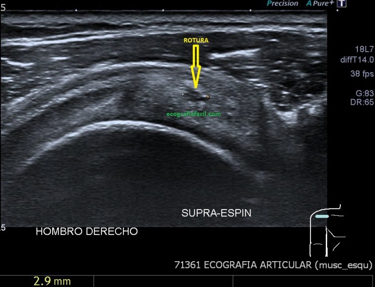 Bursitis – Ecografía Fácil