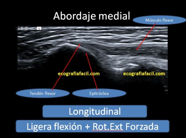 Epitrocleitis – Ecografía Fácil