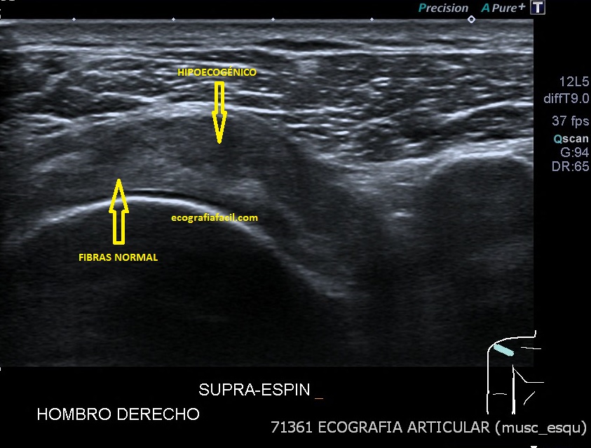 Ecografía de Hombro – Ecografía Fácil