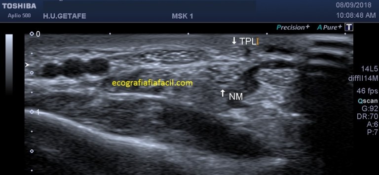 Anecoico – Ecografía Fácil