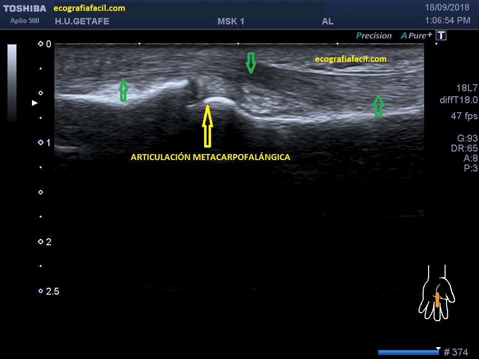 Protocolo de Mano – Ecografía Fácil
