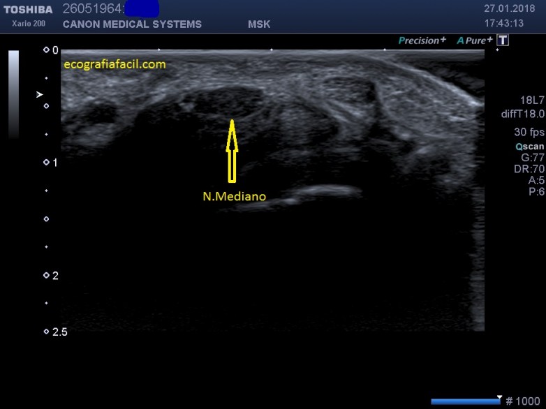Hiperecogénico – Ecografía Fácil