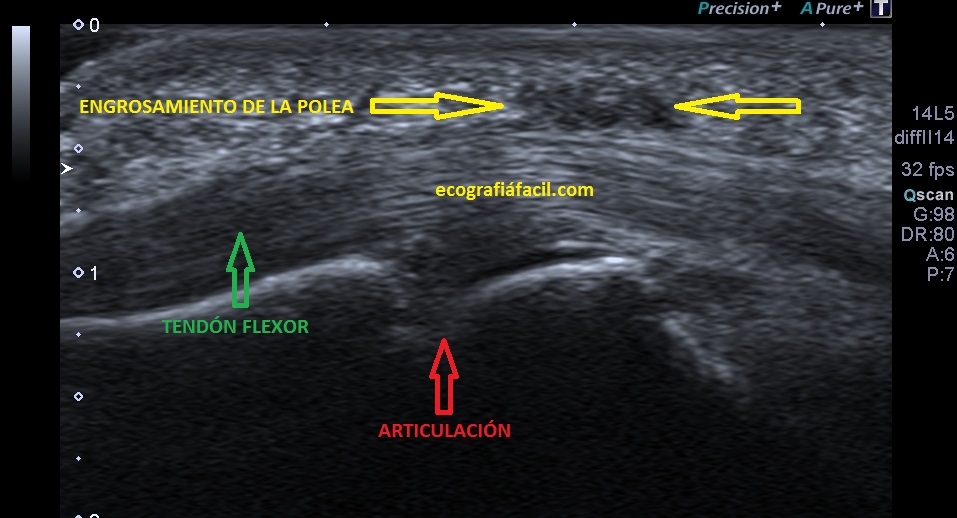 85. Patología de la región flexora de la mano. – Ecografía Fácil