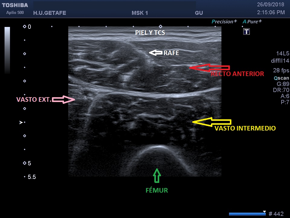Vasto – Ecografía Fácil