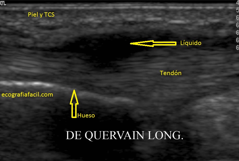 Hiperecogénico – Ecografía Fácil