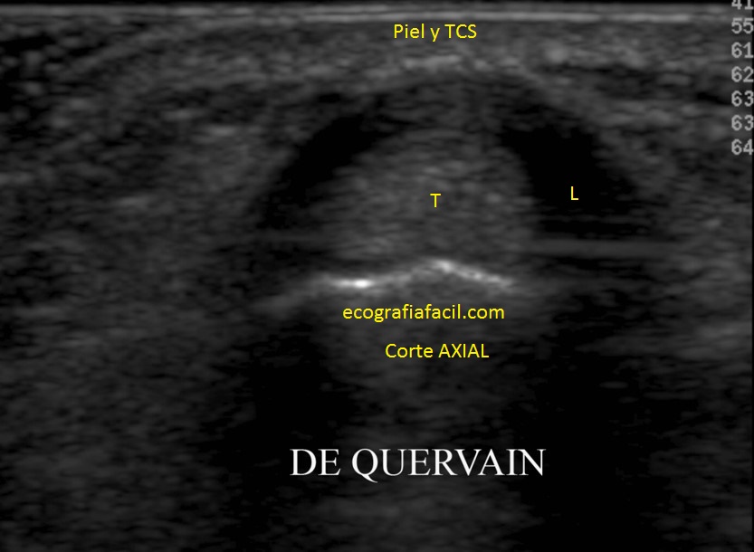 Hiperecogénico – Ecografía Fácil