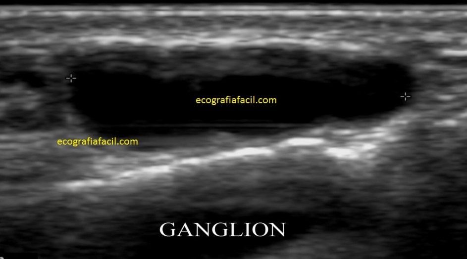 Hiperecogénico – Ecografía Fácil