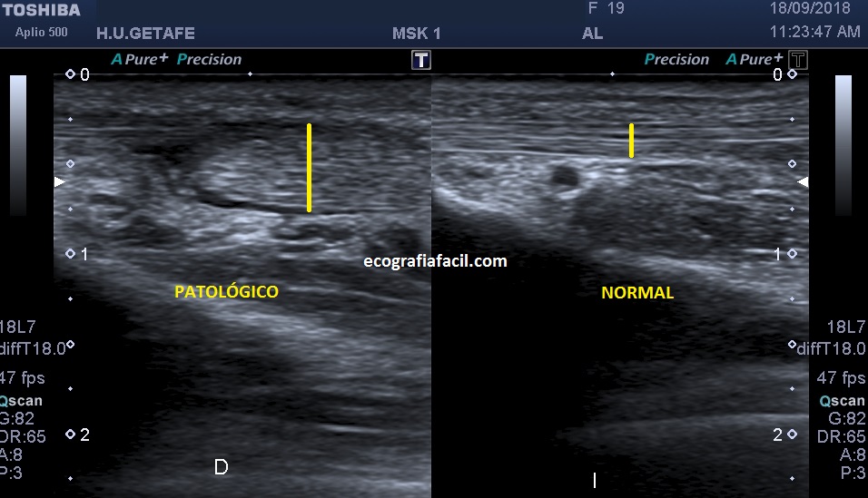 85. Patología de la región flexora de la mano. – Ecografía Fácil