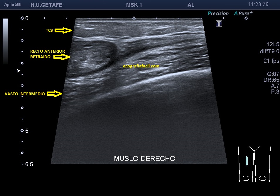 Cuadriceps – Ecografía Fácil