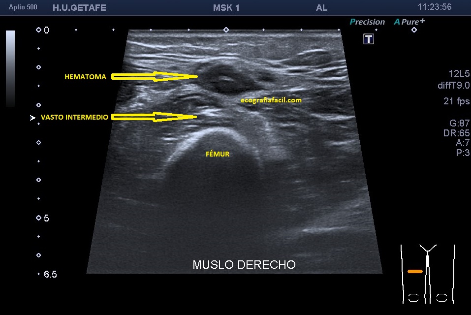 Cuadriceps – Ecografía Fácil