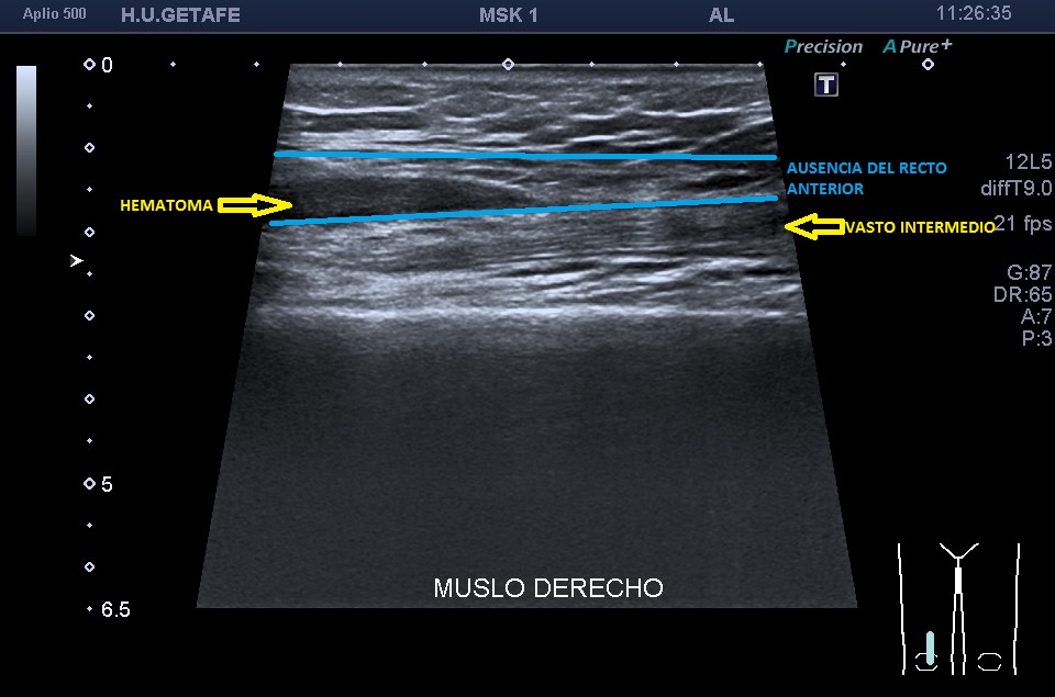 Cuadriceps – Ecografía Fácil