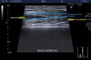 Cuadriceps – Ecografía Fácil