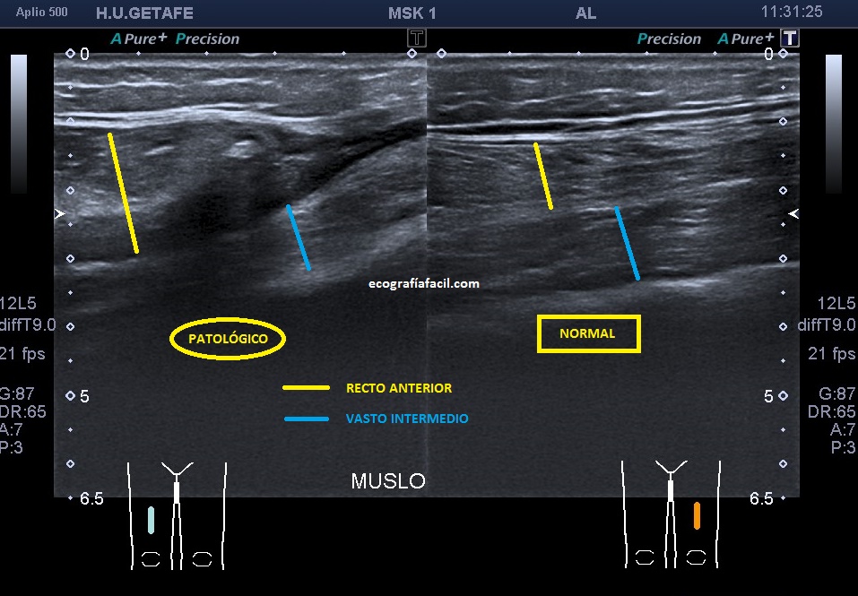 Vasto – Ecografía Fácil