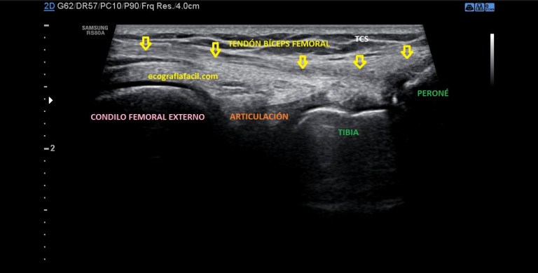 Hiperecogénico – Ecografía Fácil