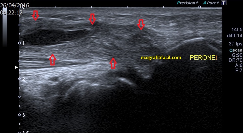 La Ecogenicidad – Ecografía Fácil