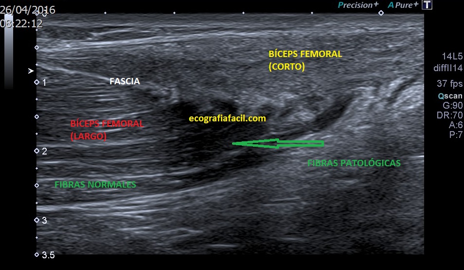 La Ecogenicidad – Ecografía Fácil