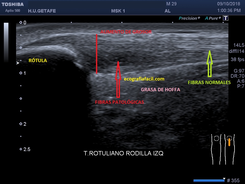 Tendón Rotuliano – Ecografía Fácil