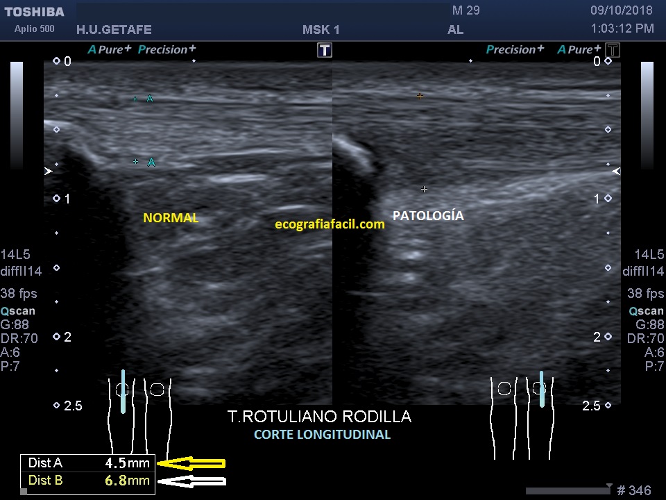 Tendón Rotuliano – Ecografía Fácil