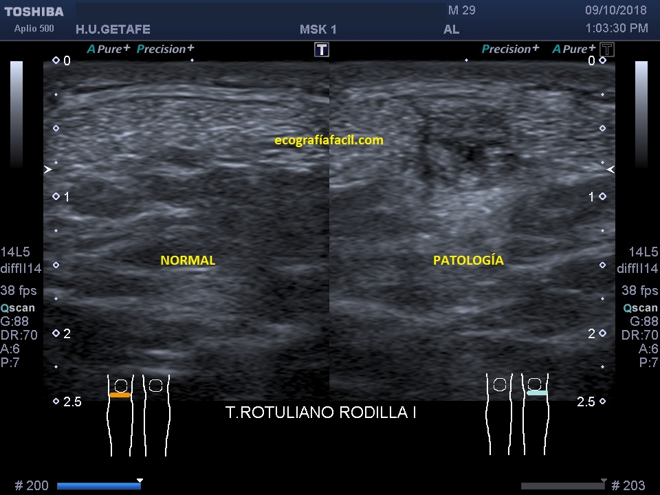 Tendón Rotuliano – Ecografía Fácil