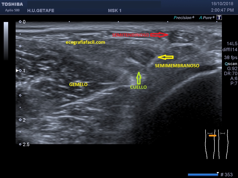 QUISTE DE BAKER – Ecografía Fácil