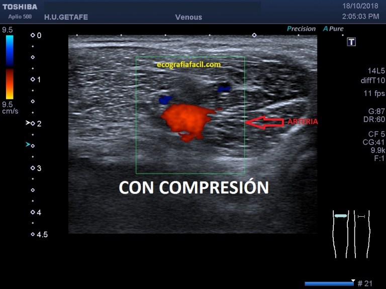 Anecoico – Ecografía Fácil