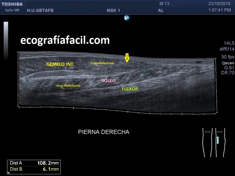 Sóleo – Ecografía Fácil
