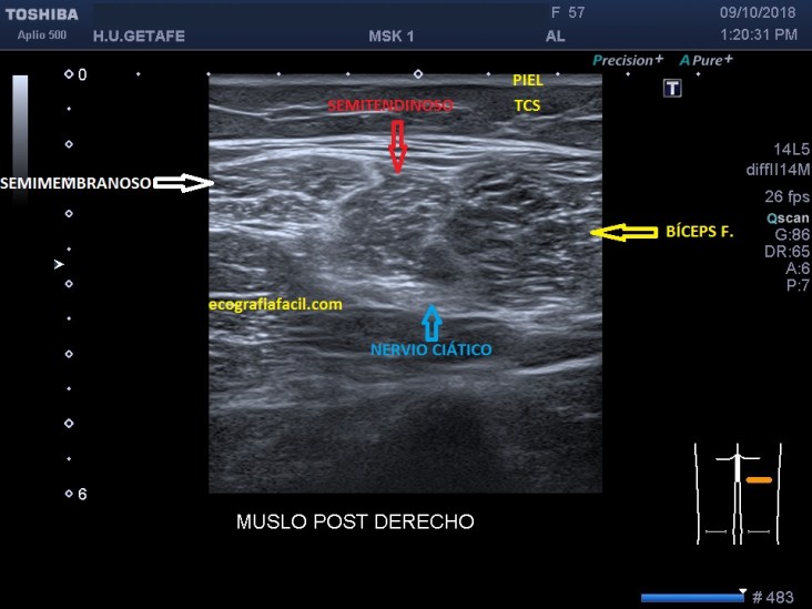 90. Muslo Posterior. Isquiotibiales. – Ecografía Fácil