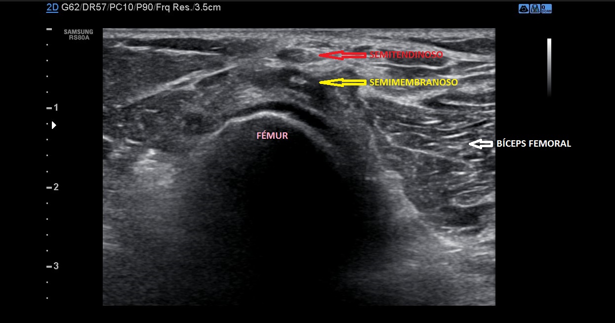 90. Muslo Posterior. Isquiotibiales. – Ecografía Fácil
