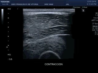Cuadriceps – Ecografía Fácil