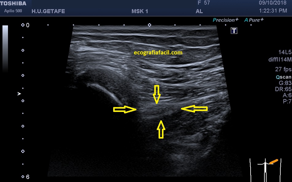 Hiperecogénico – Ecografía Fácil