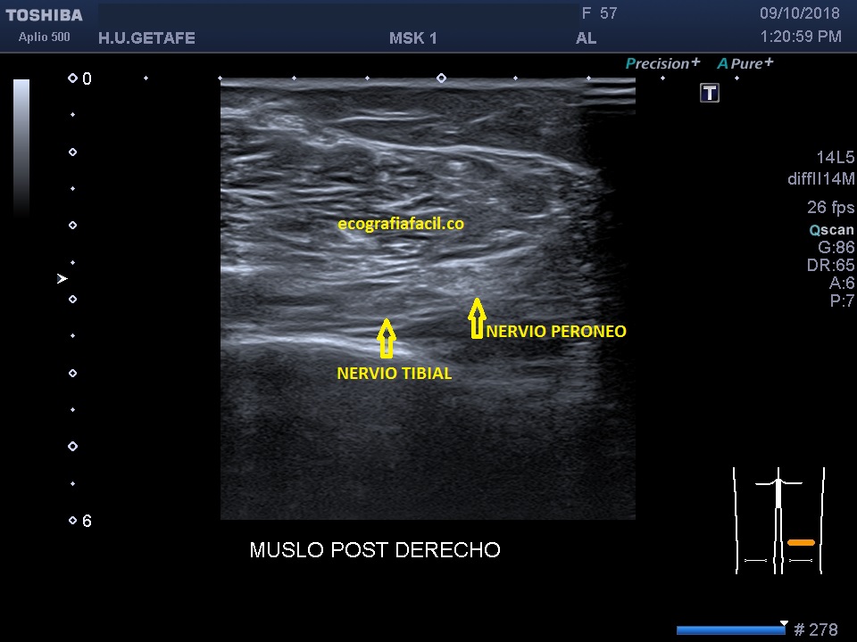 Hiperecogénico – Ecografía Fácil