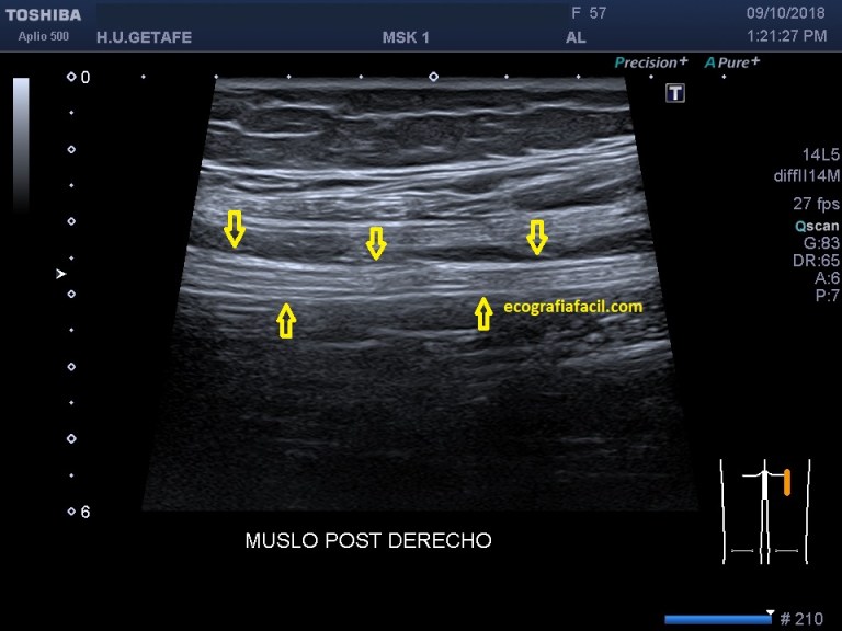 Hiperecogénico – Ecografía Fácil