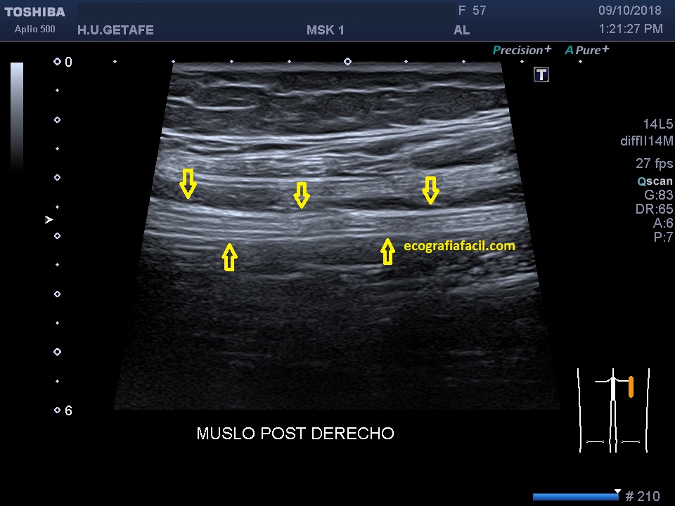 Muslo – Ecografía Fácil