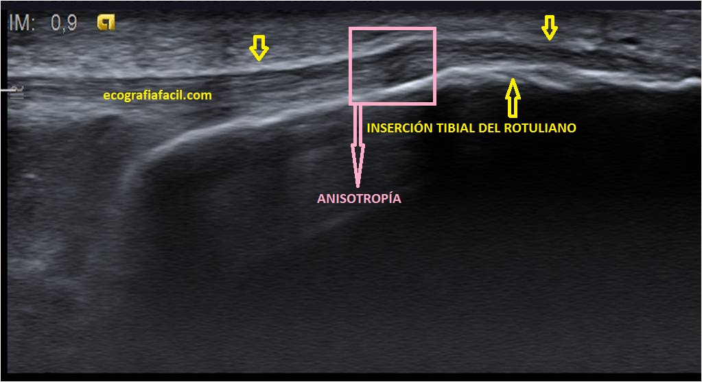 91. Aparato Expensor de la Rodilla. El Rotuliano. – Ecografía Fácil