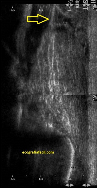 Longitudinal – Ecografía Fácil