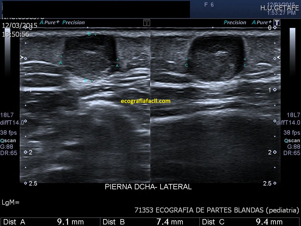 TCS – Ecografía Fácil