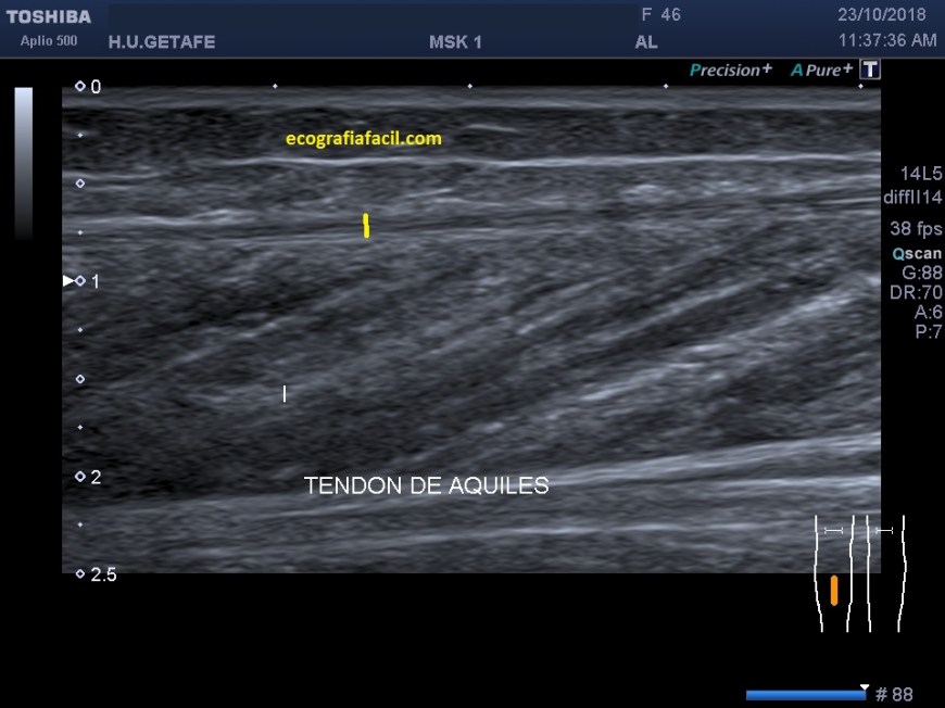 Longitudinal – Ecografía Fácil