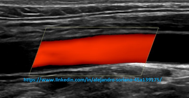 102. El Doppler.Nociones Básicas. Doppler Color. – Ecografía Fácil