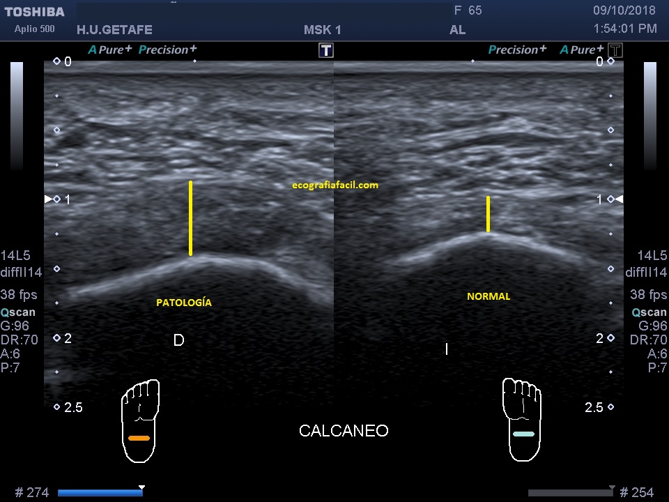 FASCITIS PLANTAR – Ecografía Fácil