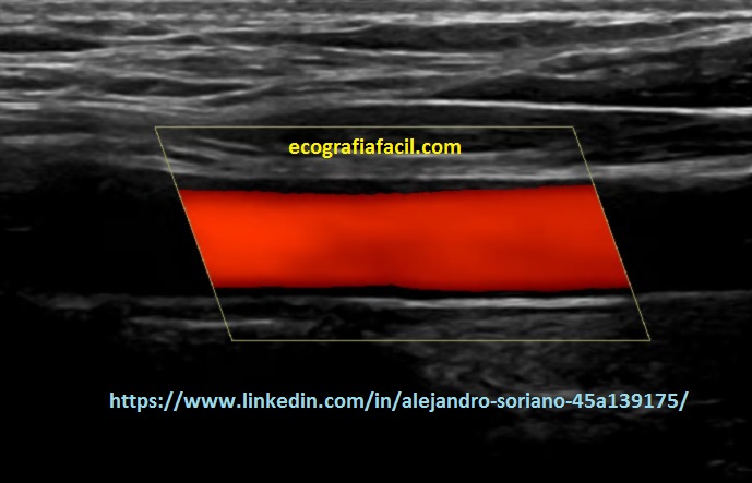 102. El Doppler.Nociones Básicas. Doppler Color. – Ecografía Fácil