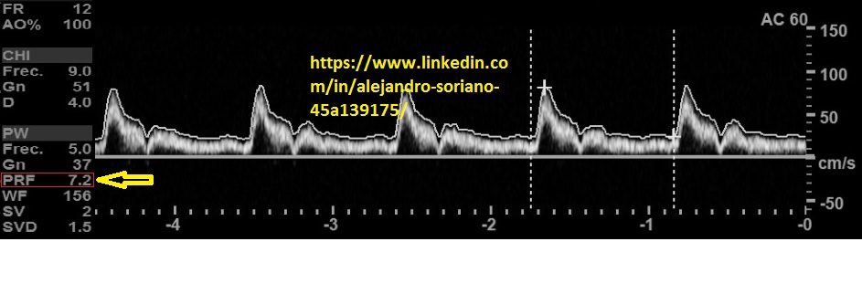 103. El Doppler Pulsado. – Ecografía Fácil