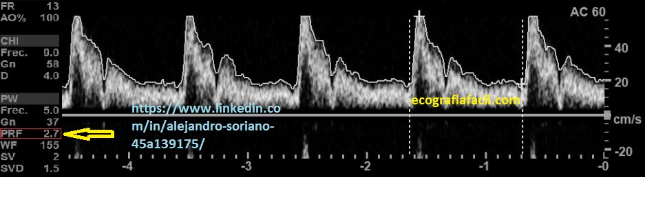 103. El Doppler Pulsado. – Ecografía Fácil