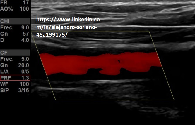 102. El Doppler.Nociones Básicas. Doppler Color. – Ecografía Fácil